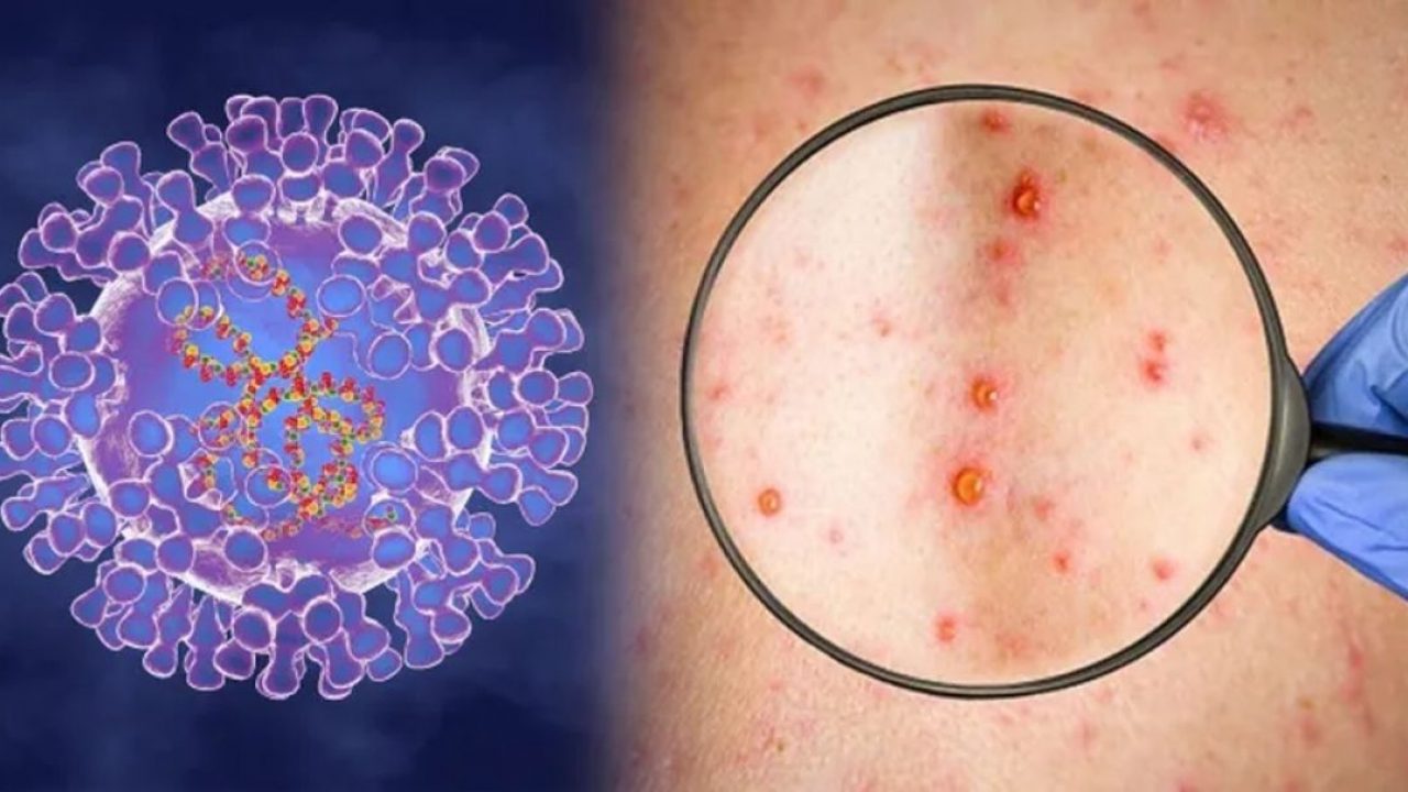 Prvi slučaj majmunskih boginja u BiH